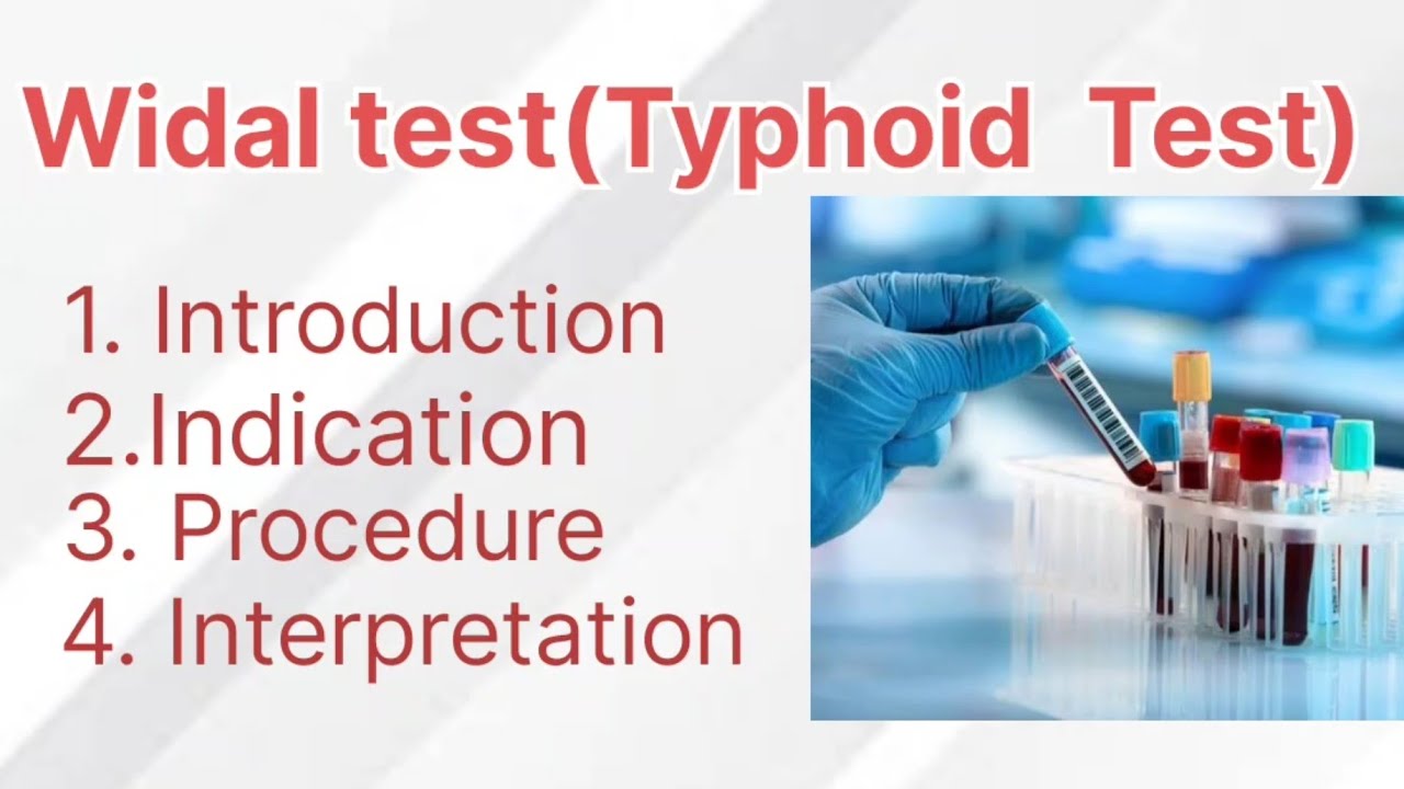 Widal Test / Widal test in English /Widal Test for Typhoid/ Report ...