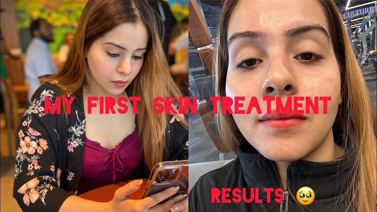 Pehli bar karaya treatment🥹||results ||skincareroutine||fitrose||# ...