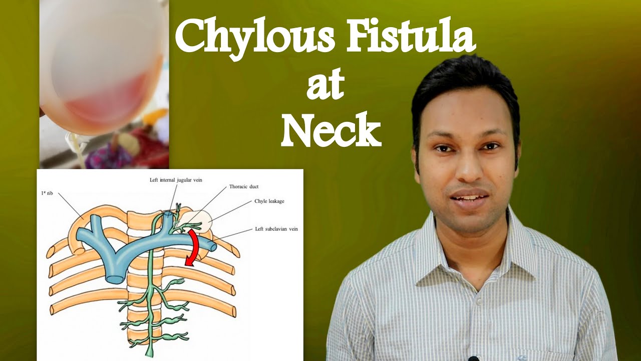 Chylous Fistula at Neck: Peroperative & Postoperative Identification ...