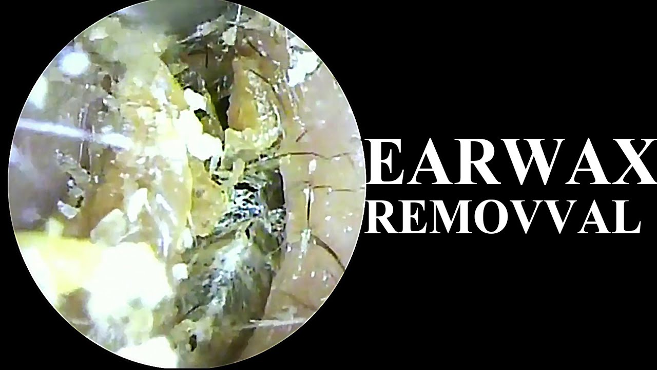 SATISFYING VIDEOS OF EAR WAX REMOVAL #181🧐🧐Teach you to deal with thick ...