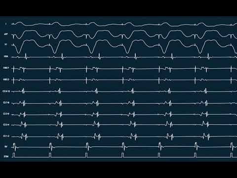 Ventricular burst pacing 2 Converted - YouTube
