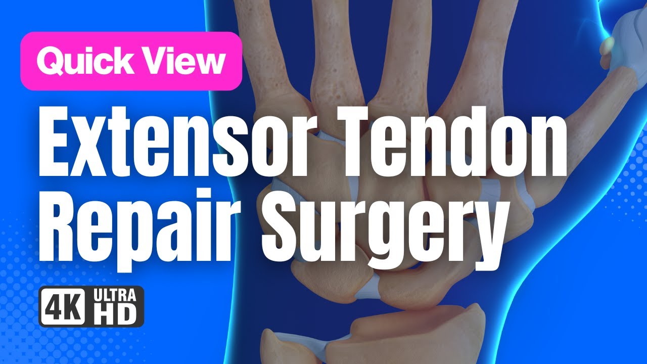 Extensor Tendon Injury Surgical Repair // See How It Works // 3D ...