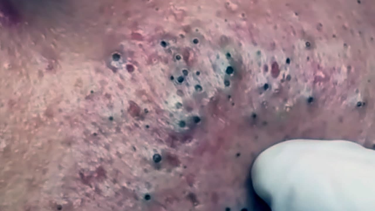 Big Cystic Acne Blackheads Extraction Blackheads & Milia, Whiteheads ...