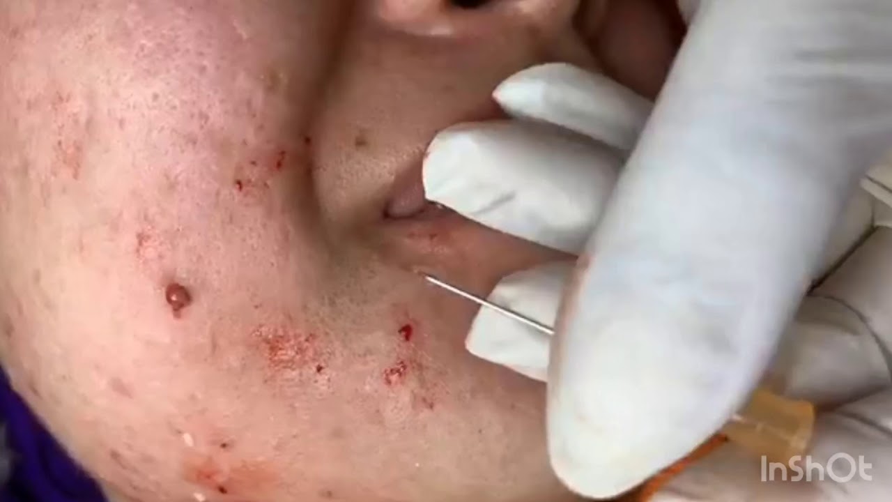 Removal acne with needles #02 - YouTube