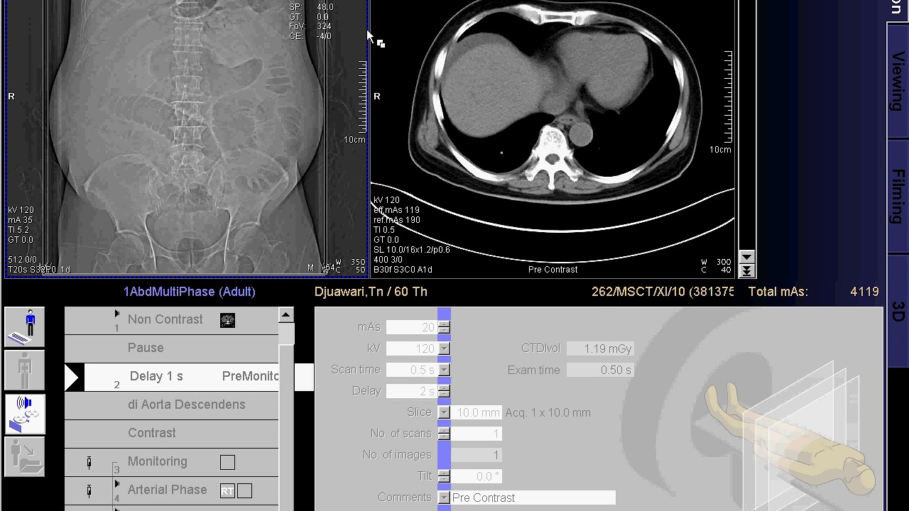 CT Scan Abdomen Ca Colon - YouTube