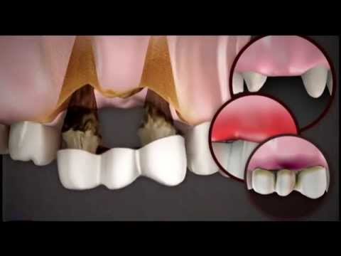 Brak pojedyńczego zęba - most a implant - YouTube