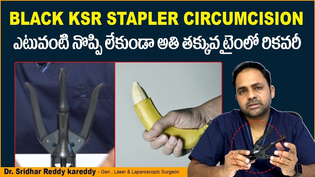 సున్తీలో అధునాతన పద్ధతి || Black KSR Stapler for Circumcision ...