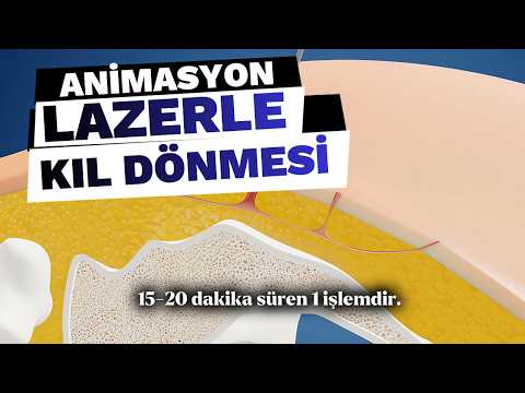 🔴 Animasyonlu Anlatım - Lazerle Kıl Dönmesi Nasıl Tedavi Edilir? 💥