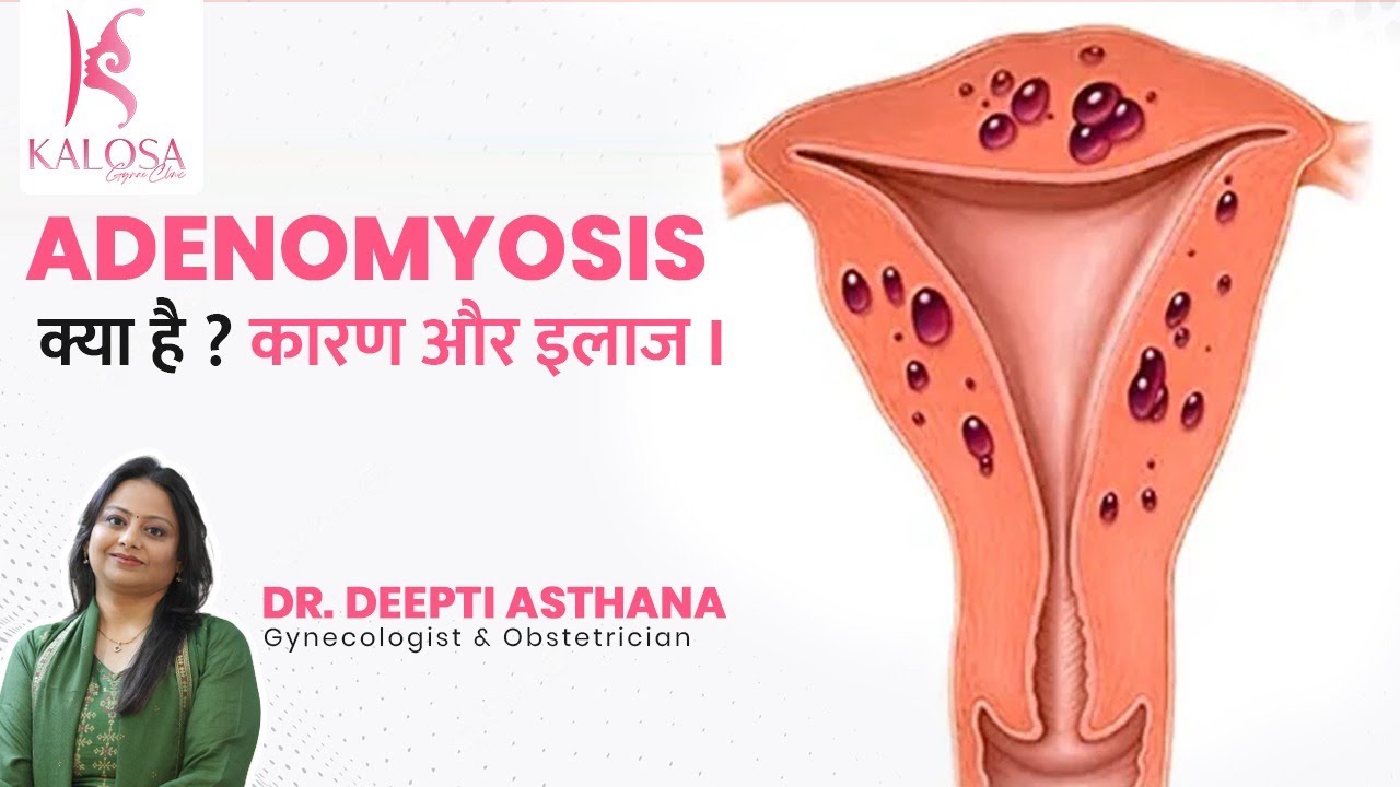 Adenomyosis Symptoms Causes And Treatment Adenomyosis adenomyosis-symptoms-causes-and-treatment-adenomyosis