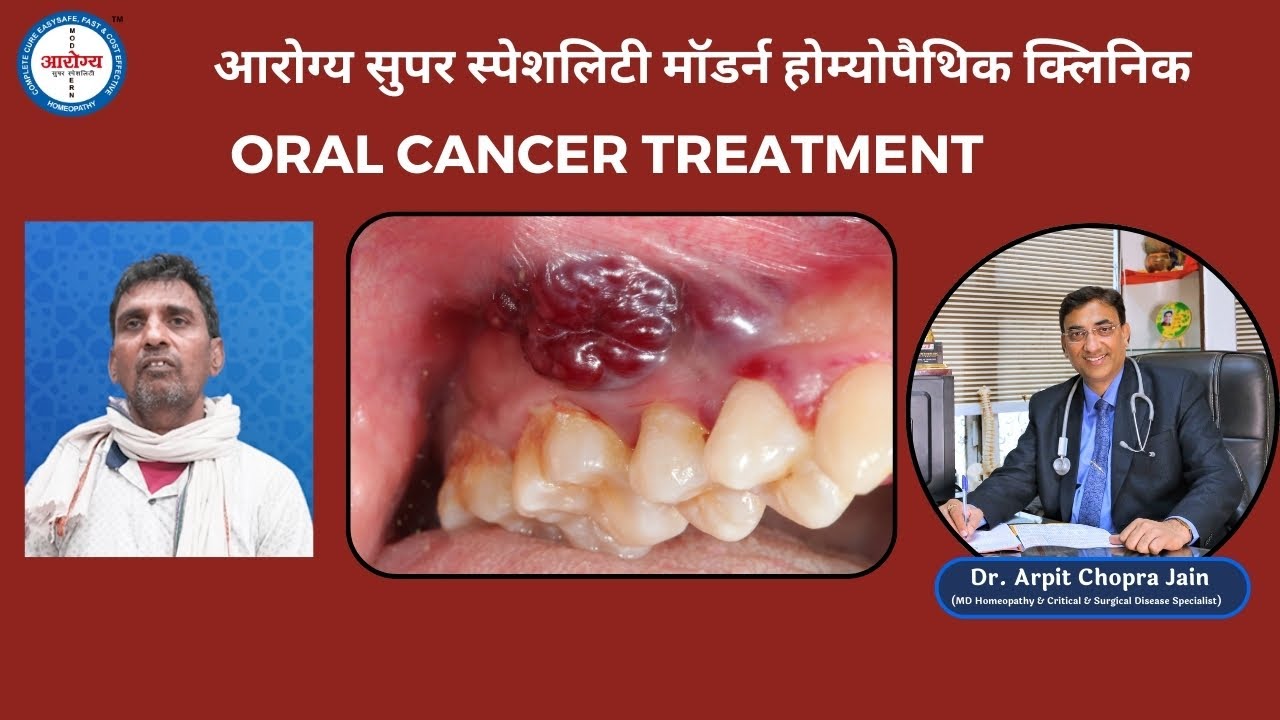 Oral Cancer Patient From Firozabad treated by Dr. Arpit Chopra Jain at ...