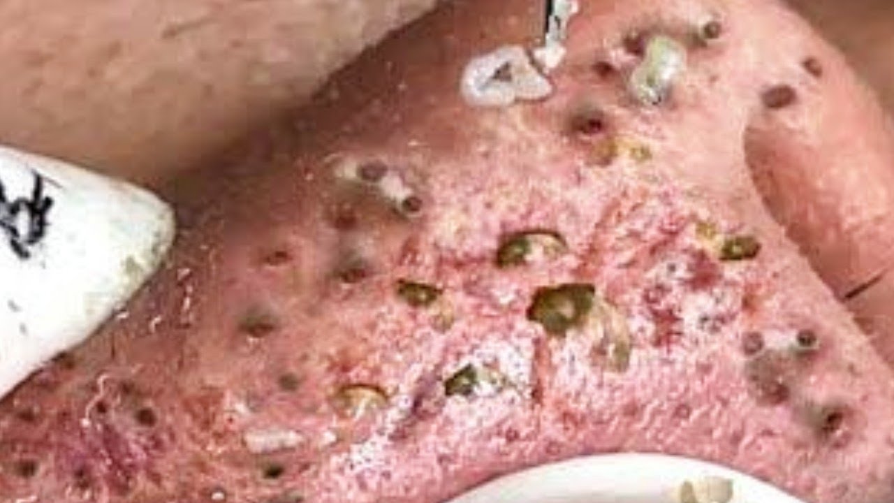 Big Cystic Acne Blackhead, Extraction Blackheads & Milia #237 ...