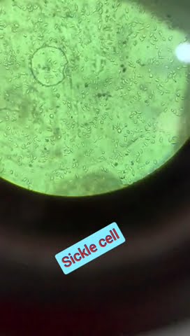 Sickle cells under microscope #shorts #youtubeshorts #viral #community ...