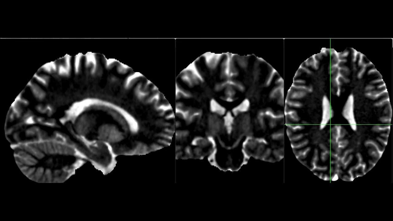 high resolution ute-mt mri using novel rosette kspace trajectory - YouTube