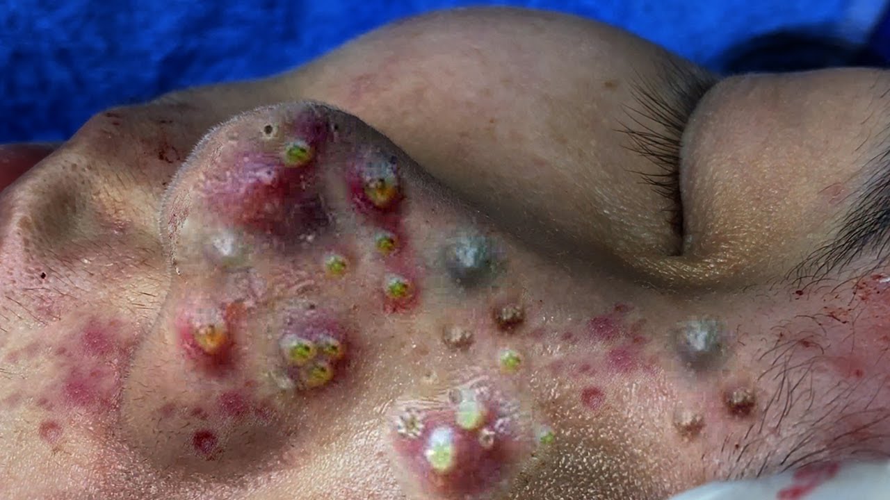 𝐌𝐨𝐬𝐭 𝐒𝐚𝐭𝐢𝐬𝐟𝐲𝐢𝐧𝐠 𝐏𝐢𝐦𝐩𝐥𝐞𝐬 𝐑𝐞𝐦𝐨𝐯𝐚𝐥 𝐀𝐭 𝐇𝐨𝐦𝐞 #920 - YouTube