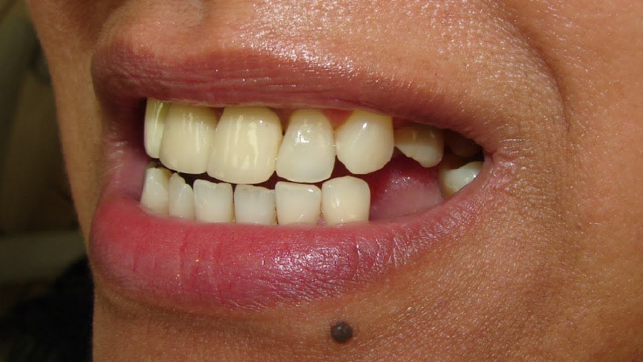 Prótese De Silicone Dente - RETOEDU