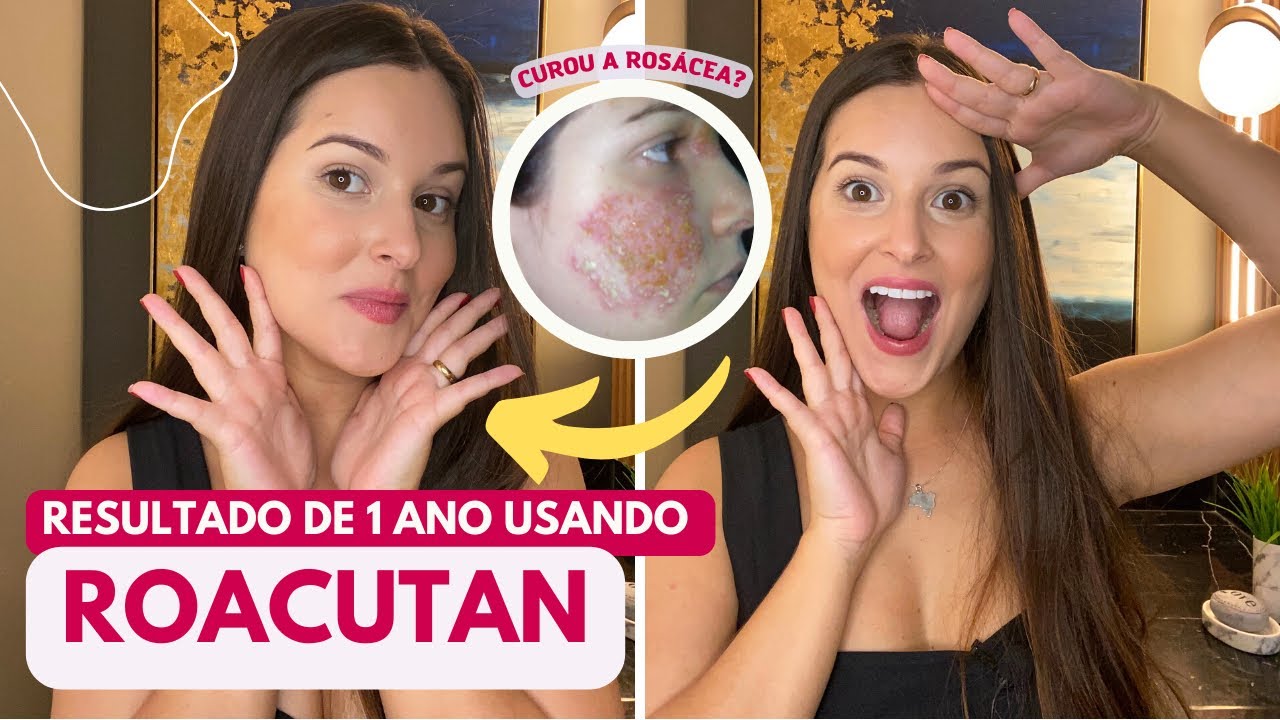 RESULTADO DO ROACUTAN - Curou a rosácea? - YouTube