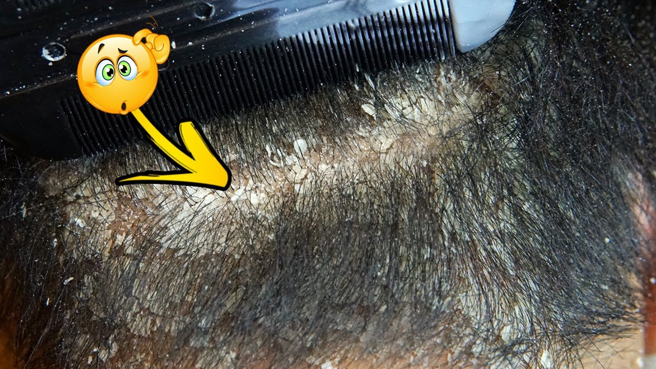 HUGE FLAKES!!! Extreme Dandruff Scalp Scratching and Picking - YouTube