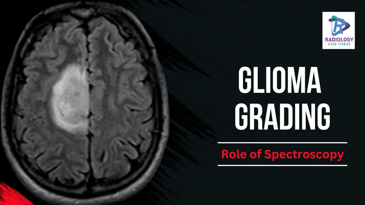 Glioma grading | Spectroscopy | Umamaheswara Reddy.V - YouTube