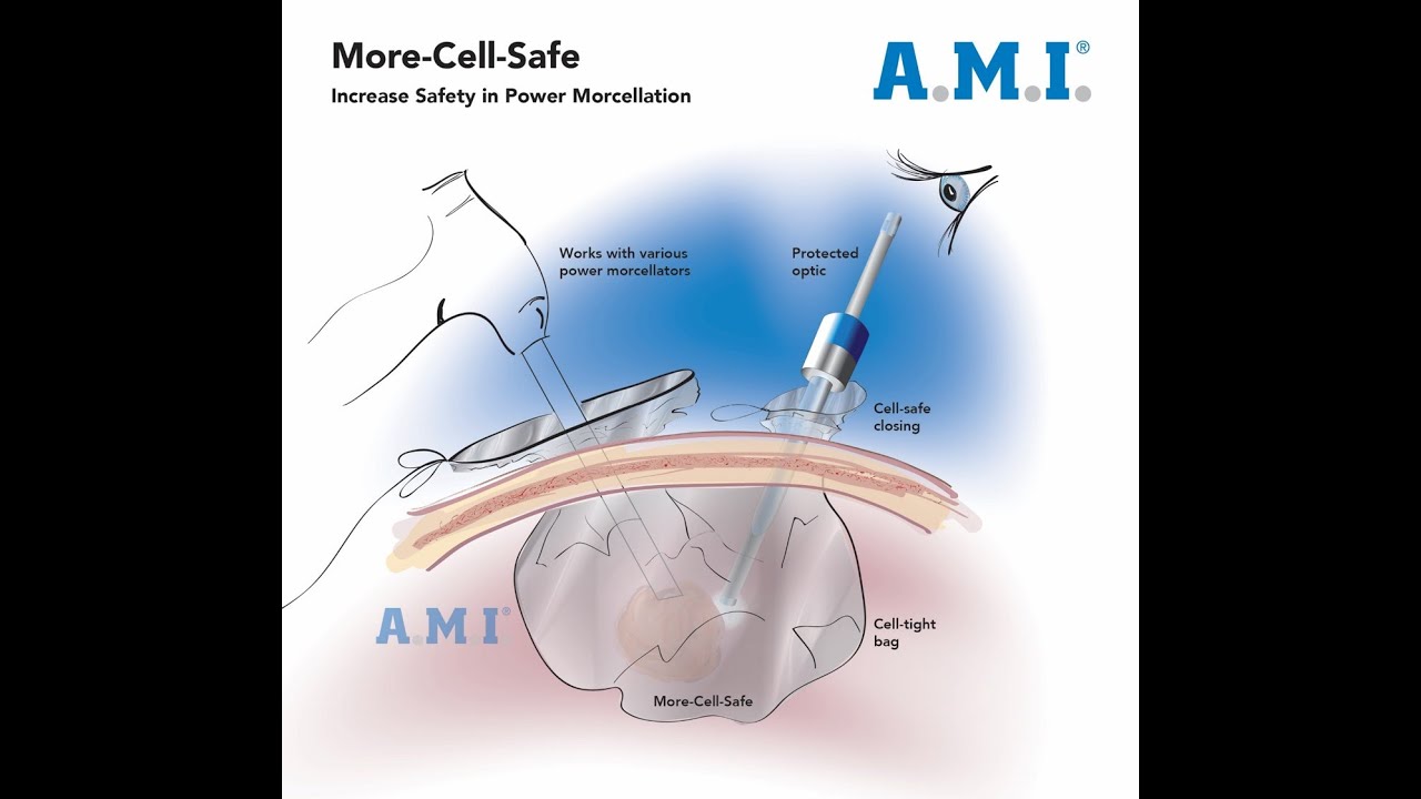 More-Cell-Safe from A.M.I.: Increased safety, in-bag-morcellation ...