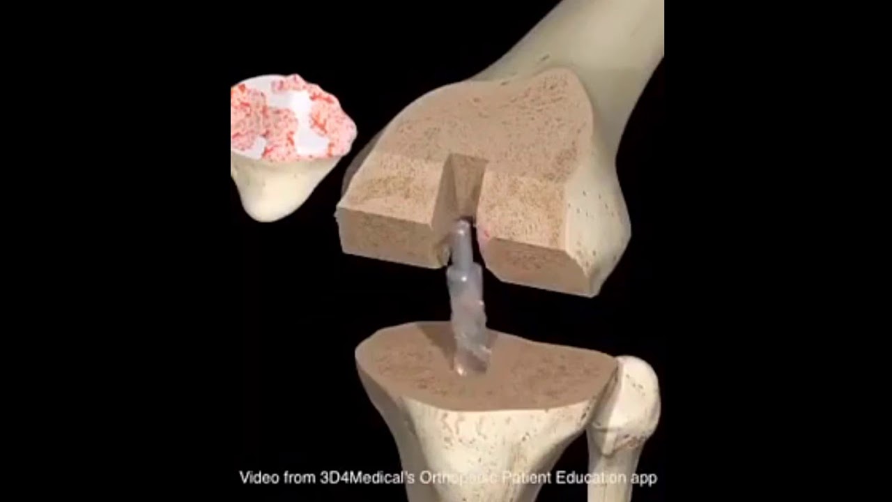 Proses Operasi penggantian sendi bagi penderita osteoarthritis atau ...