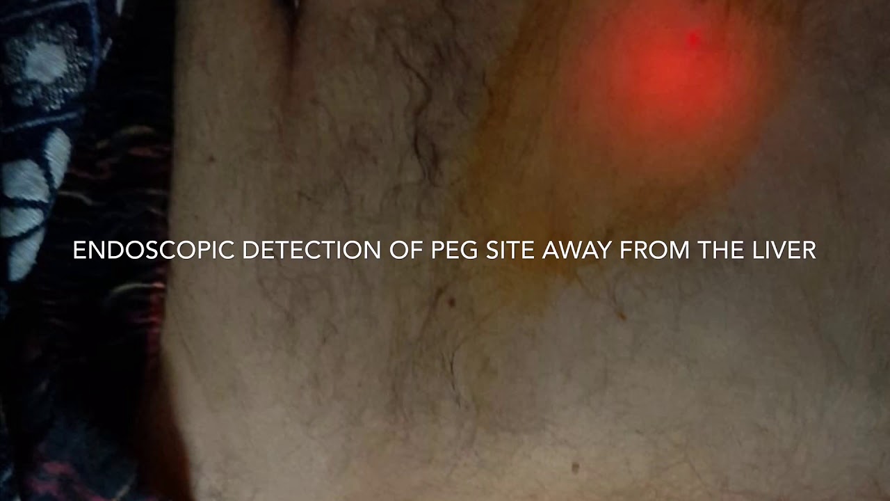 PEG tube insertion - pull technique- D Tamer Hydara - YouTube