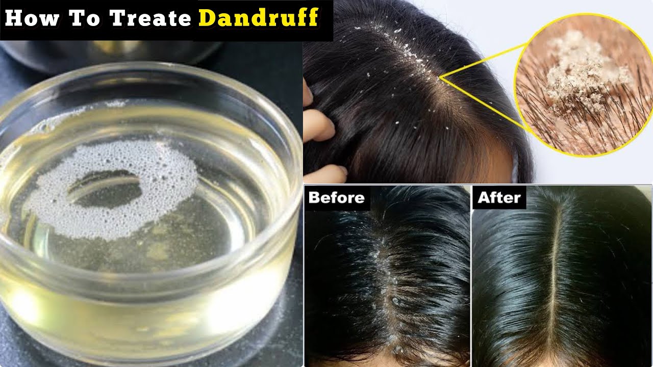 Get Rid Of Dandruff In 1 Day | How To Remove Dandruff At Home | Hair ...