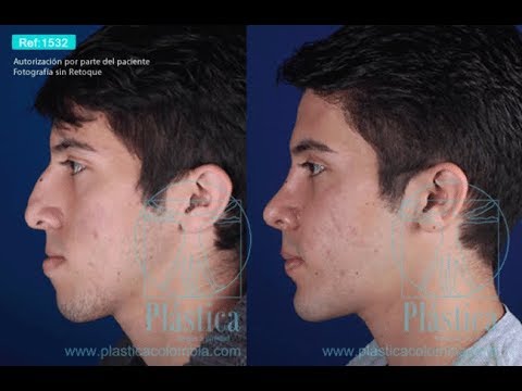 Procedimiento Maxilofacial: Prognatismo (Deficiencia Tercio Medio ...