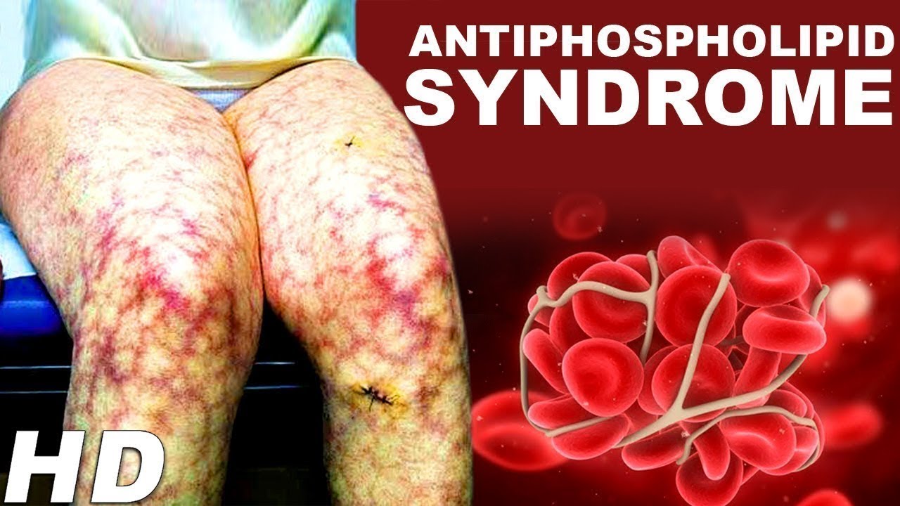 Antiphospholipid Antibody Syndrome An Autoimmune Disease ...
