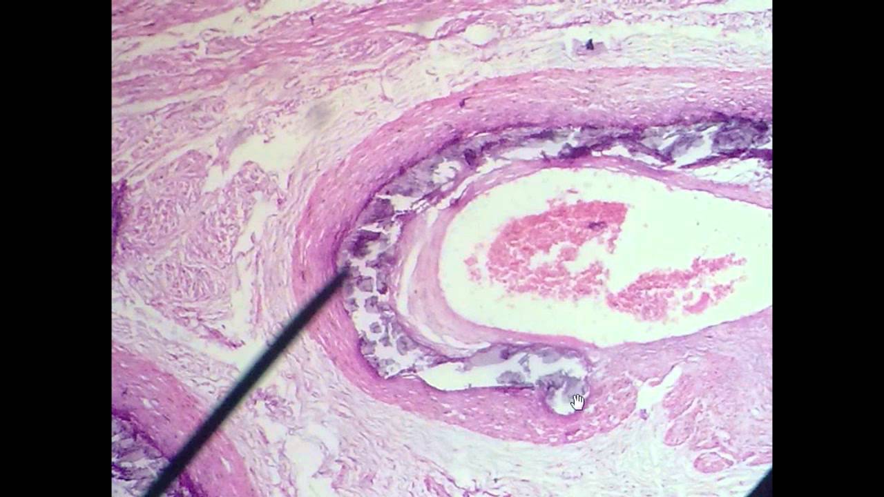 Patologia Facil - Utero (Calcificacion distrofica) - YouTube