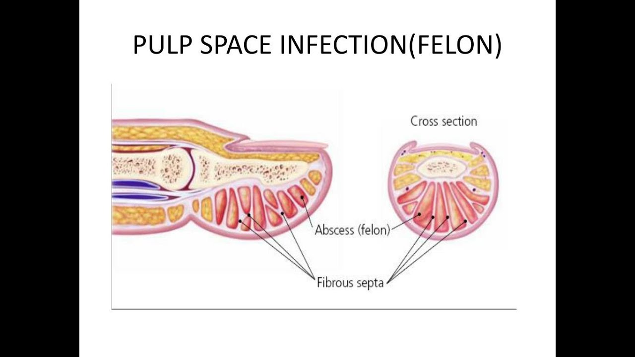 Why Infections of Pulp Space of the Digits may cause Avascular Necrosis ...