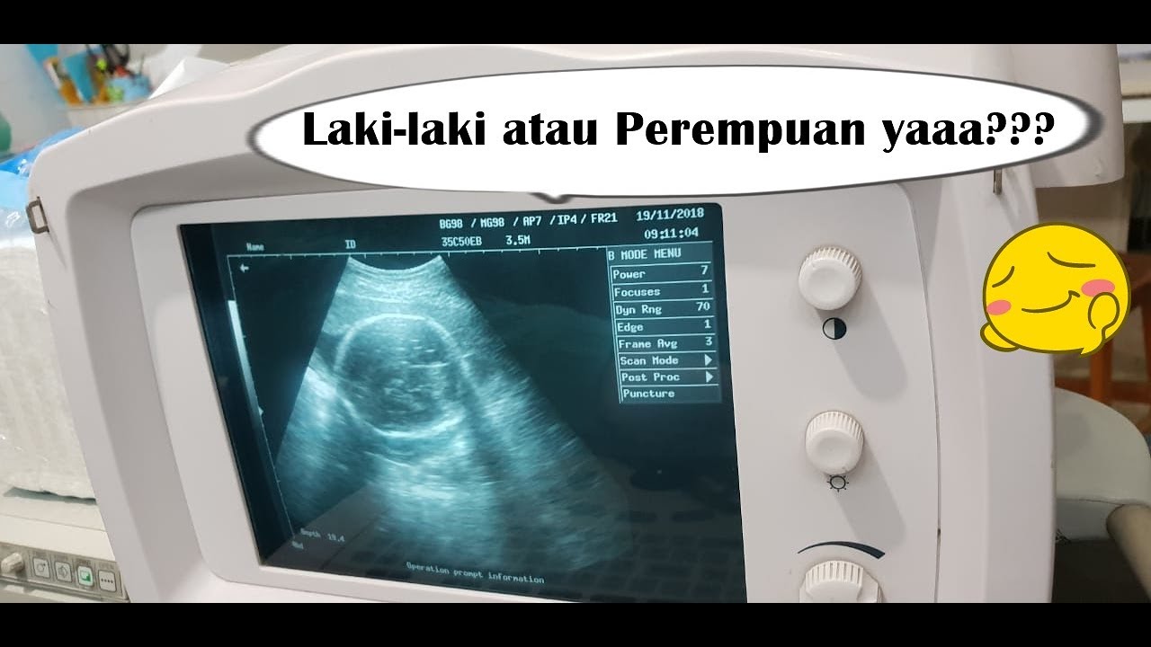 USG Jenis Kelamin (2 Dimensi) saat Usia Kandungan 7 Bulan (Periksa ...