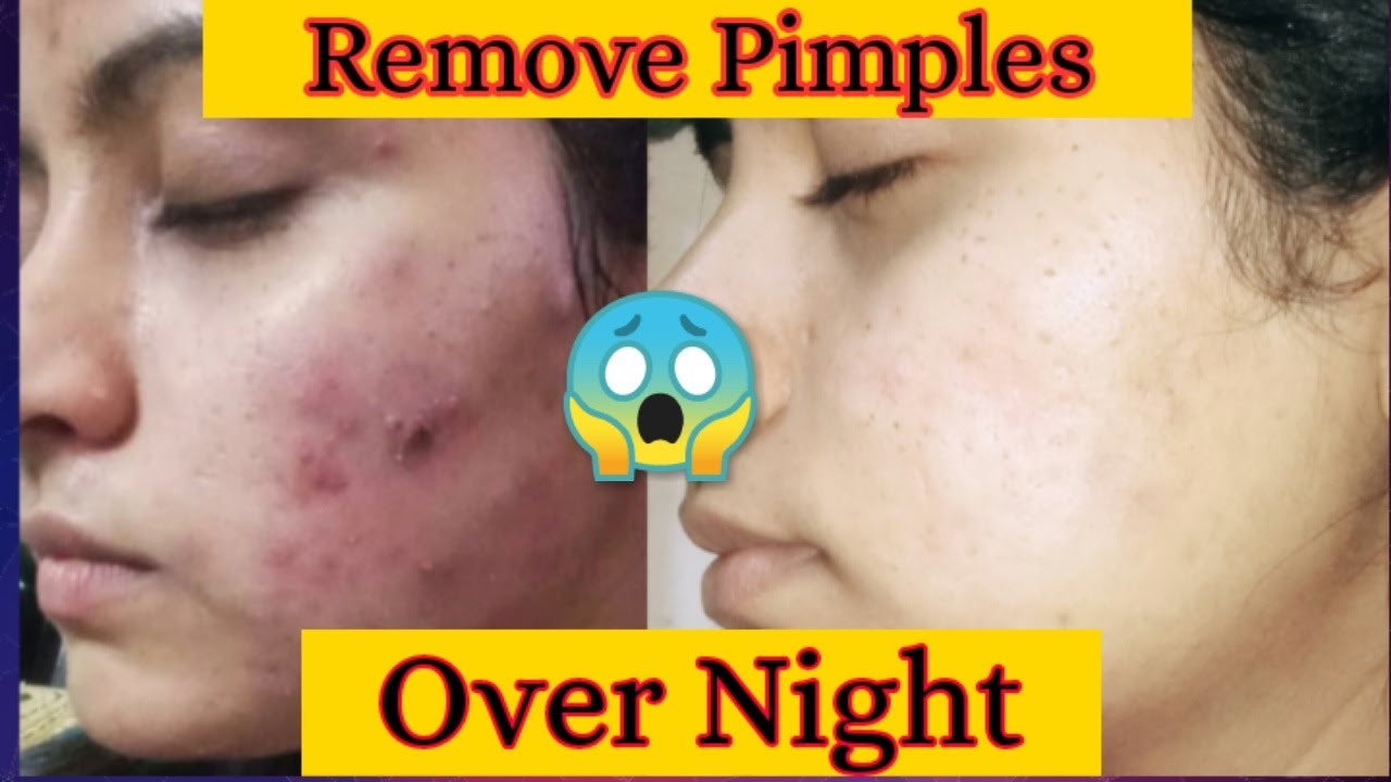 How to remove pimples? **Acne + Marks Treatment ** - YouTube