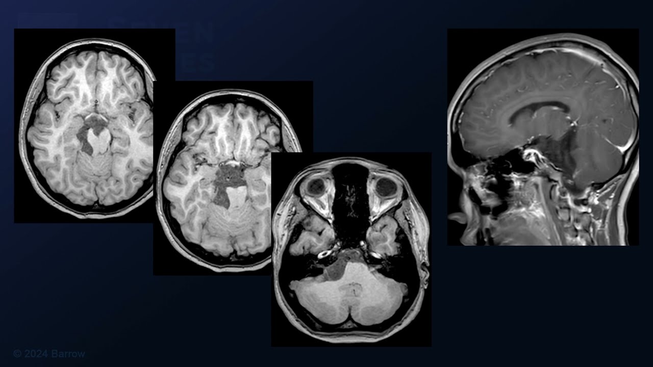 Extended Retrosigmoid Craniotomy For Resection Of An Epidermoid Tumor extended-retrosigmoid-craniotomy-for-resection-of-an-epidermoid-tumor