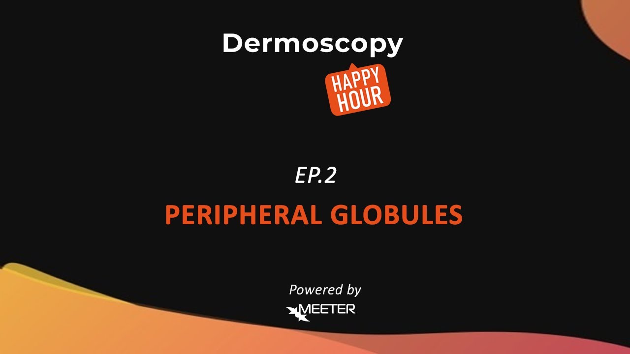 Dermoscopy Happy Hour - SEASON 2 EPISODE 2 "Peripheral Globules" - YouTube