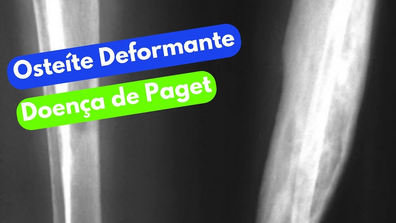 DOENÇA DE PAGET - OSTEÍTE DEFORMANTE - Dr. Prof. Nelson Marques - YouTube