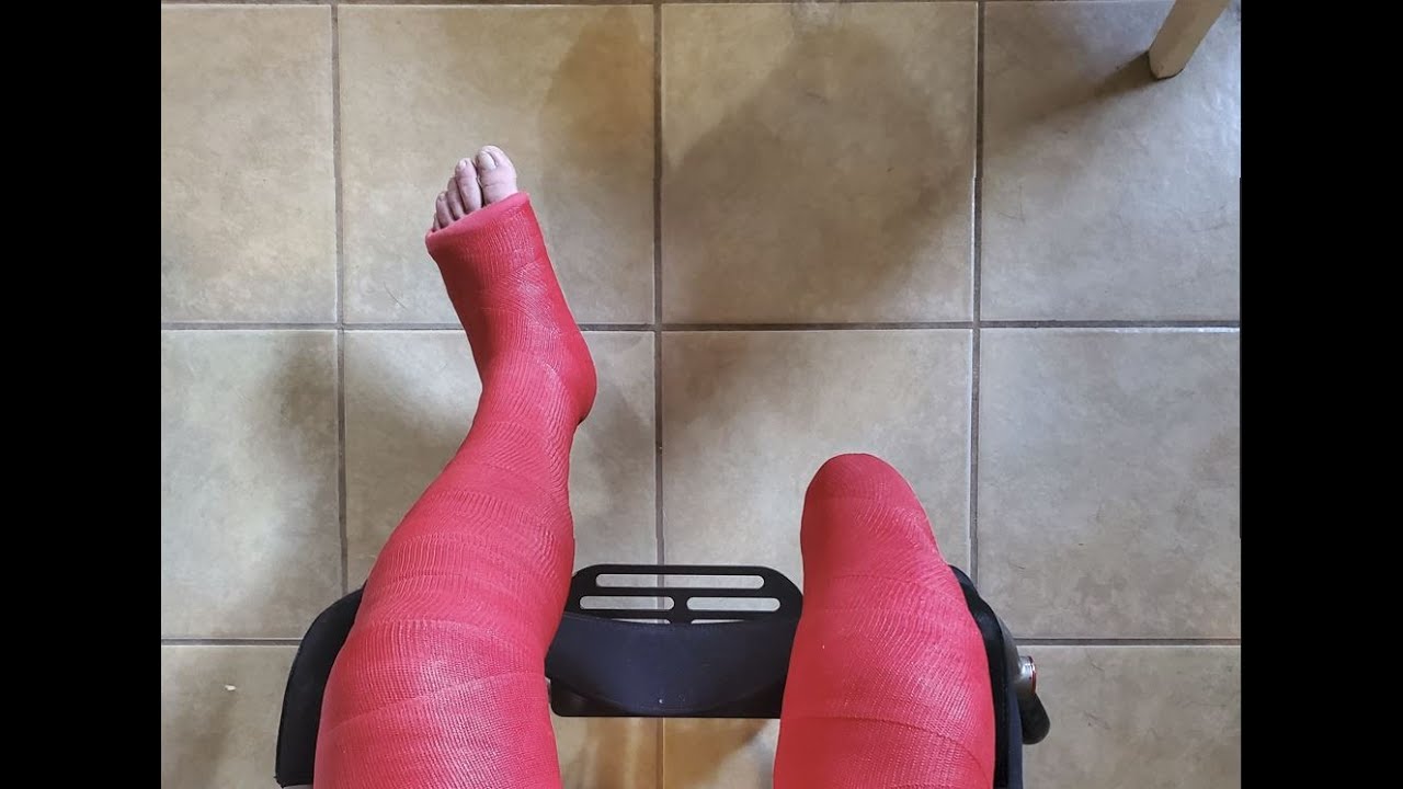 2 broken legs, but can I still wear a prosthetic? - YouTube
