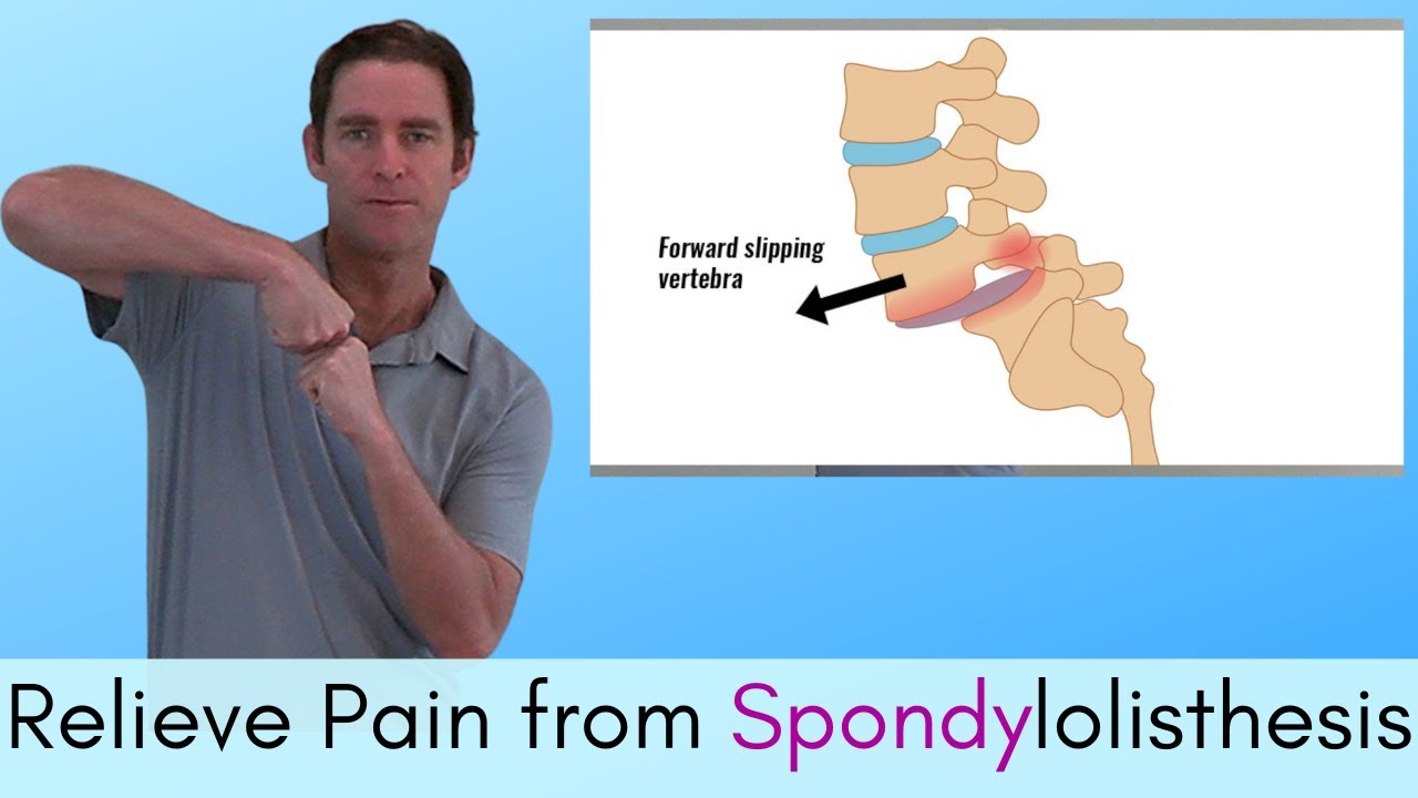 The Best Spondylolisthesis Treatment, Exercises and Information - YouTube