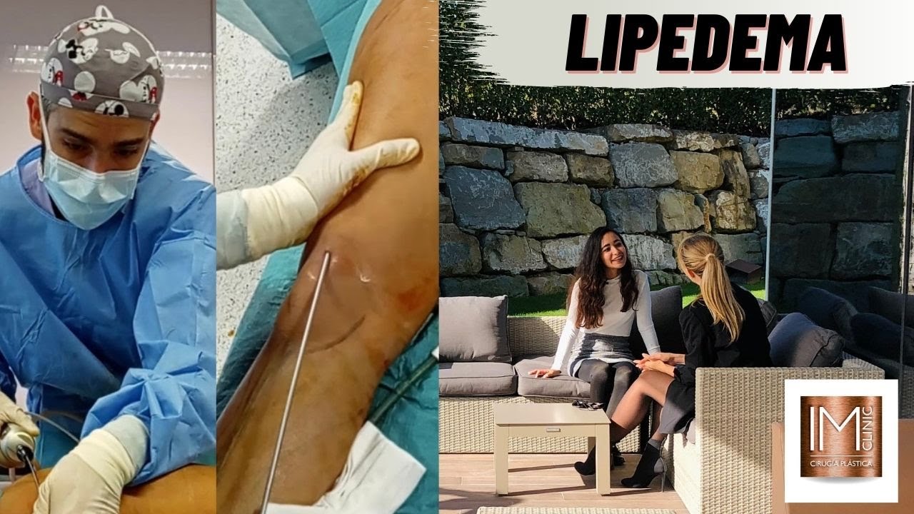 LIPEDEMA ‼️ / MI CIRUGÍA DE LIPEDEMA EN IM CLINIC - BARCELONA/ Imagenes ...