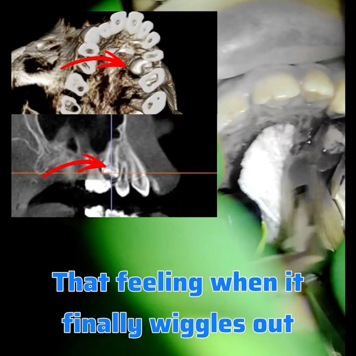 That Feeling when the Tooth Finally Wiggles Out - YouTube