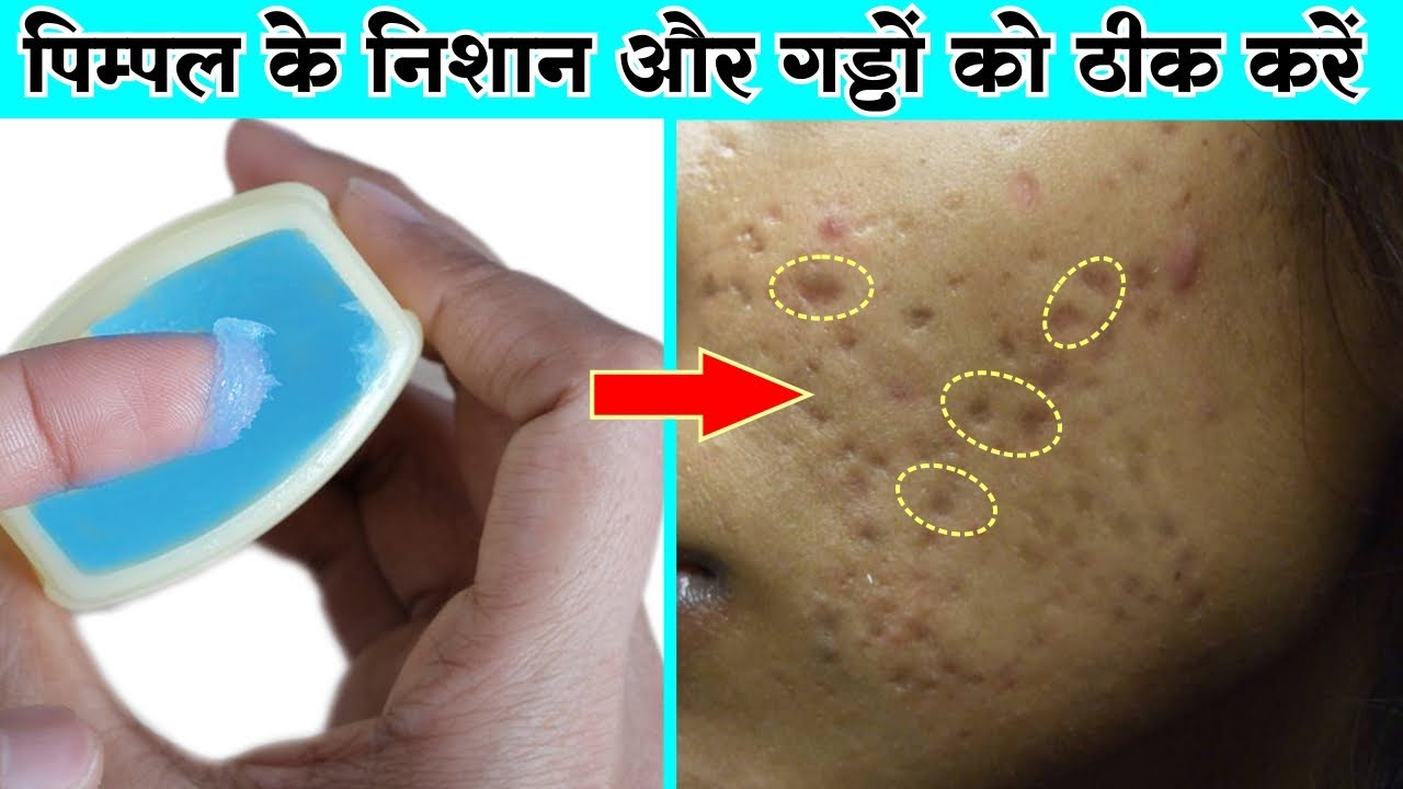 चेहरे के गड्ढे और निशान ठीक करने के कामियाब नुस्खे | Get Rid of Acne ...