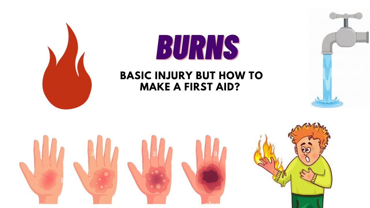 Burns - Degrees, size and first aid - YouTube