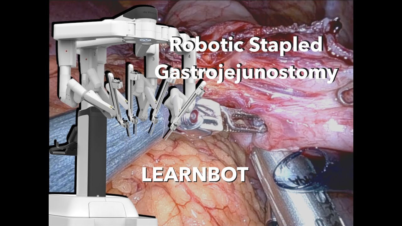 Robotic Stapled Gastrojejunostomy Instruction Video LEARNBOT - YouTube