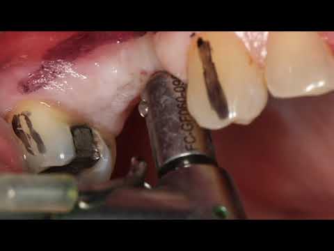 MD Guide Implant Spacing, Surgical Guide, Implant Placement, Pilot ...