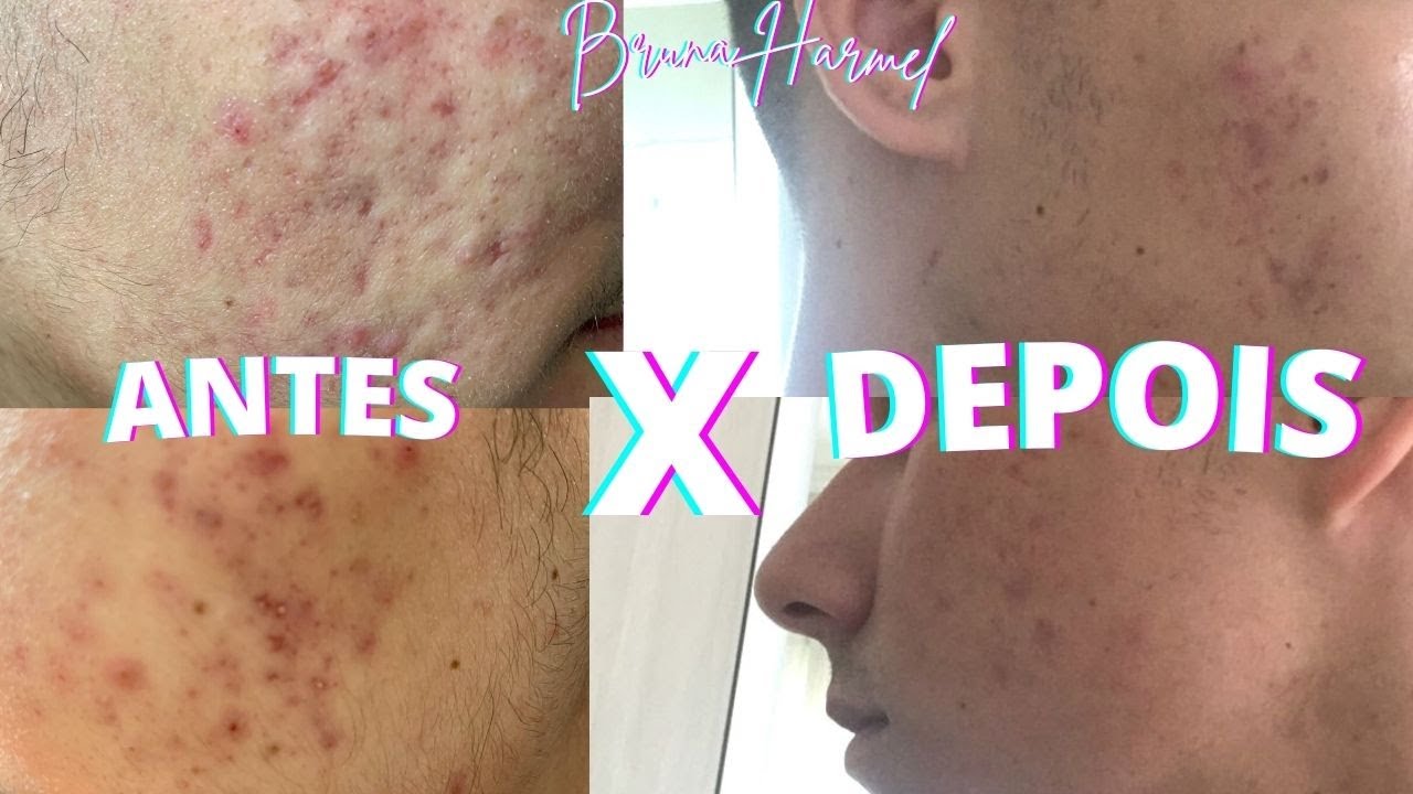 ANTES E DEPOIS DA ACNE - Bruna Harmel - YouTube