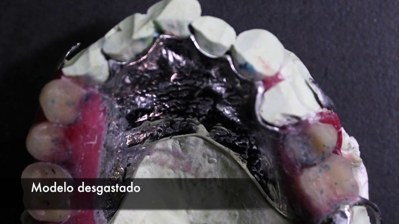 Enmuflado Protesis Removible - Odontología UV - YouTube