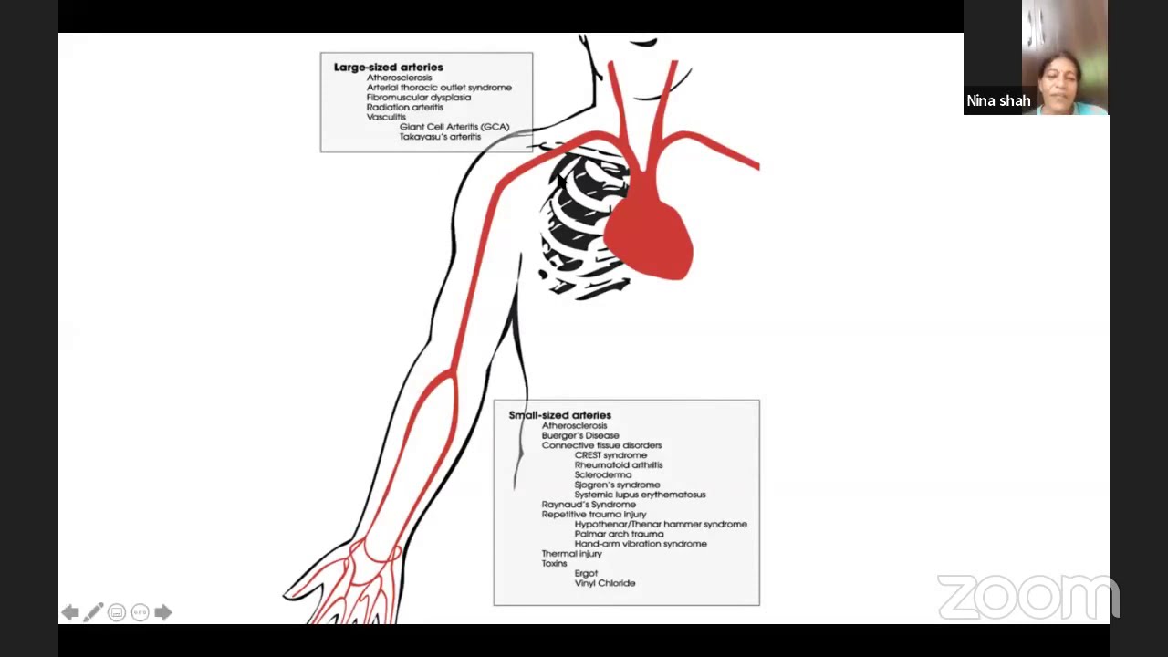 Seminar on Upper Limb Ischaemia - YouTube