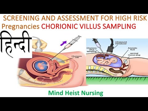 SCREENING AND ASSESSMENT FOR HIGH RISK (CHORIONIC VILLUS SAMPLING ...