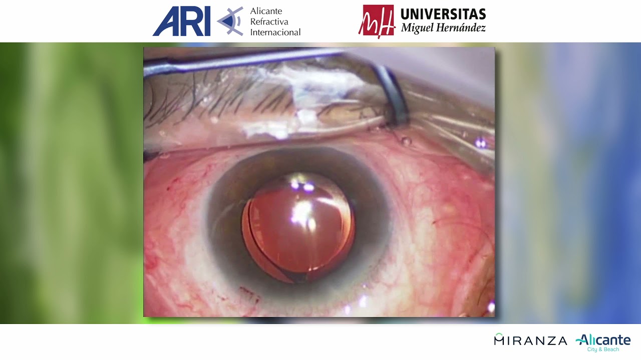 ARI 2021 | Caso Clínico | 12 | Dr. Enrique Suárez: Verus Ring - YouTube