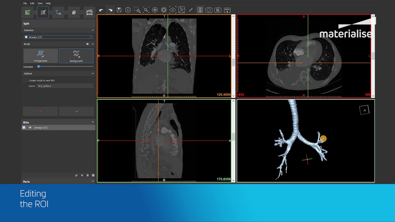 How to Segment Airways | Mimics InPrint Tutorial - YouTube