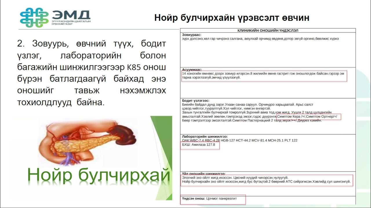 Нойр булчирхайн үрэвсэлт өвчин Youtube